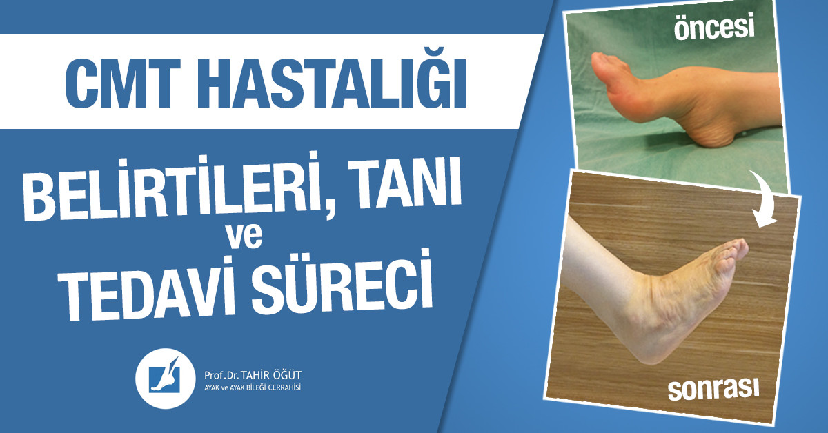 Aşil Tendiniti (tendinopatisi) Hakkında Bilinmesi Gerekenler